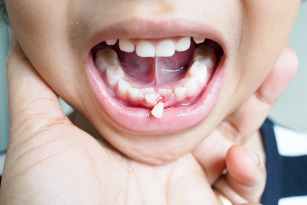 Knocked-Out Tooth Norlane Geelong - Norlane Dental Aesthetics and Implants Knocked-Out Tooth Norlane Geelong - Norlane Dental Aesthetics and Implants
